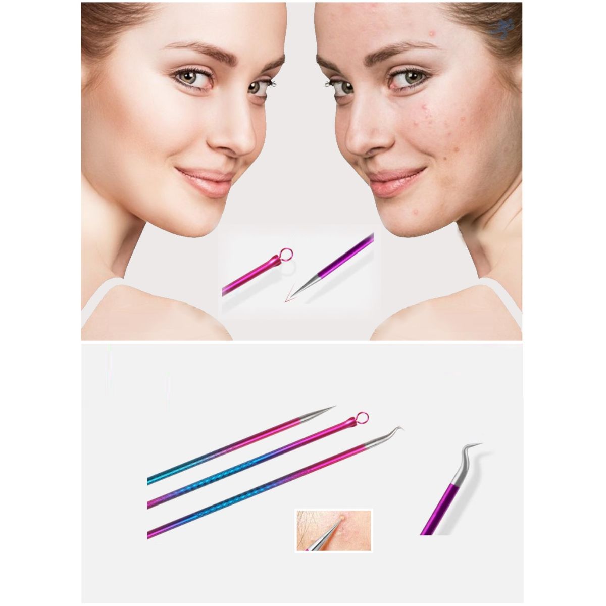 Alati za uklanjanje akna i mitesera 3-dijelni